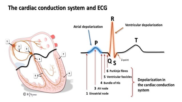 New onset of atrial fibrillation pptx.pptx