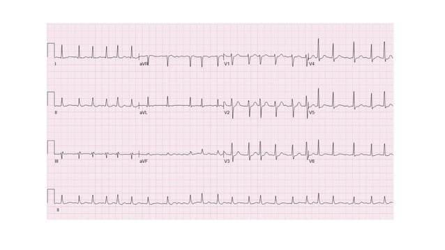 New onset of atrial fibrillation pptx.pptx