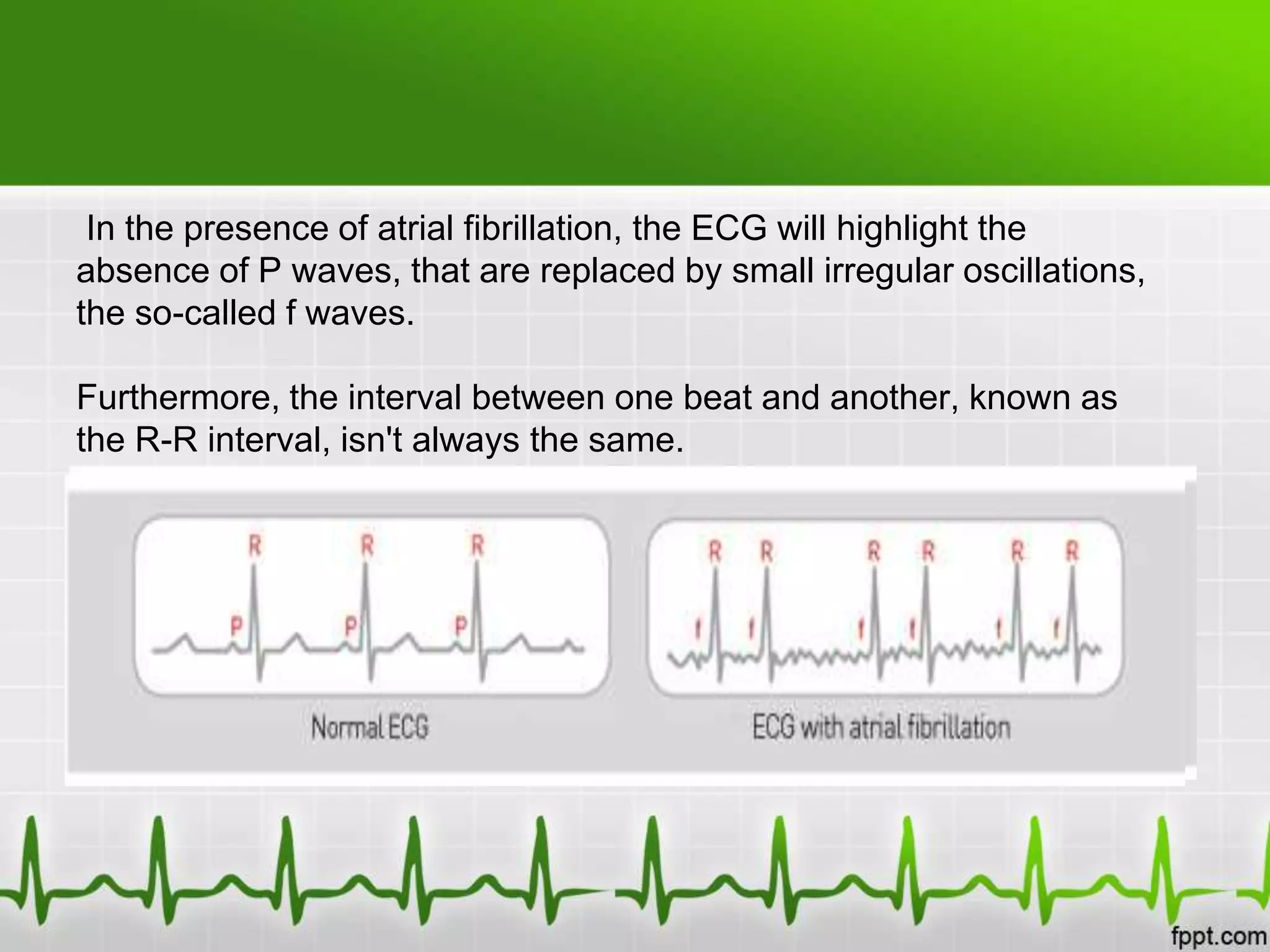 Atrial fibrillation & Atrial flutter | PPTX