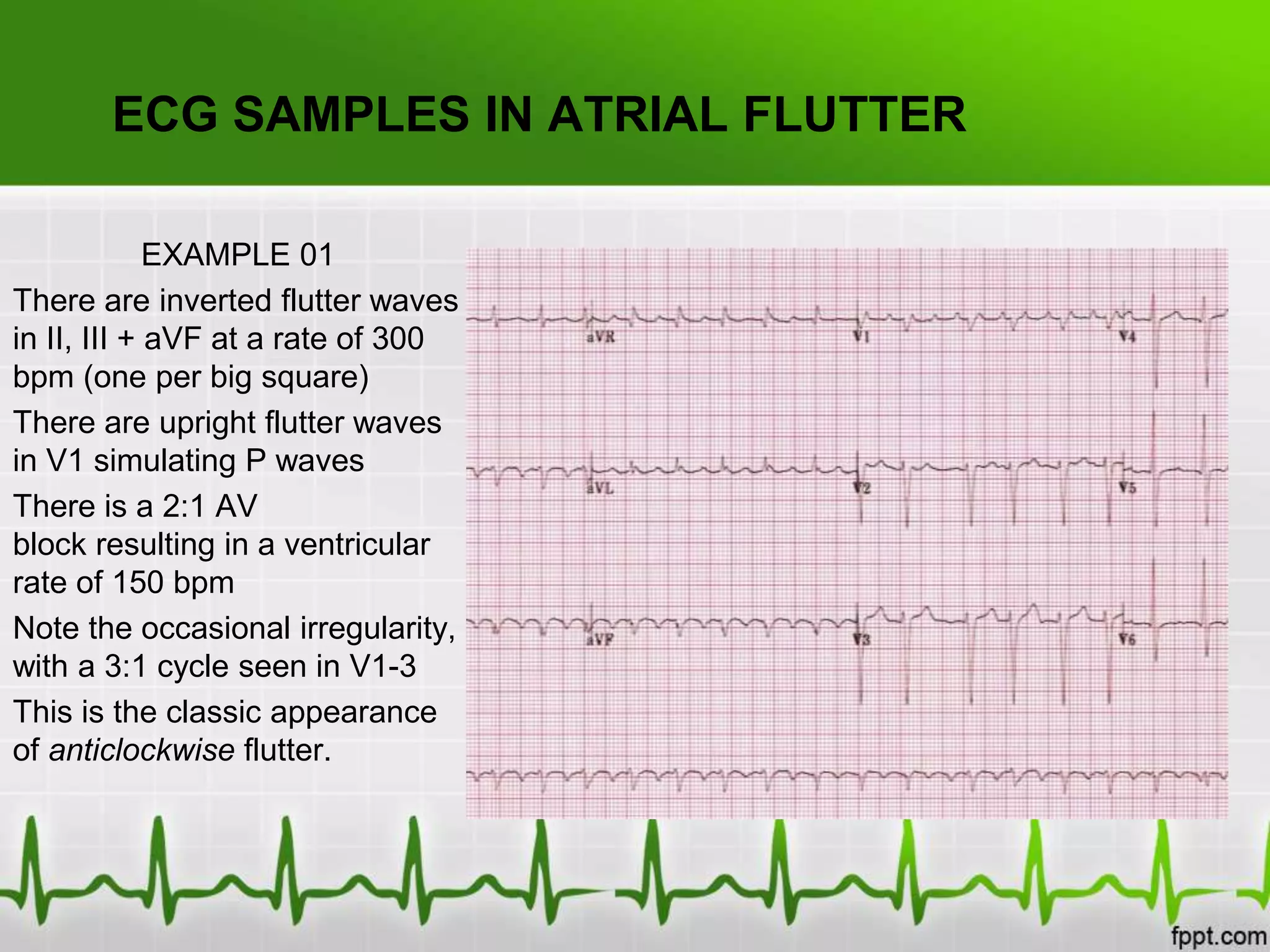 Atrial fibrillation & Atrial flutter | PPTX