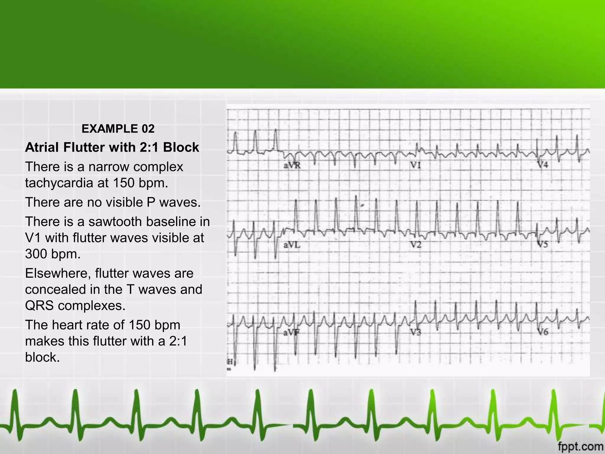 Atrial fibrillation & Atrial flutter | PPTX