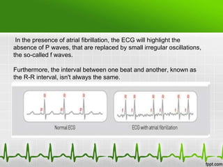 Atrial fibrillation & Atrial flutter | PPTX