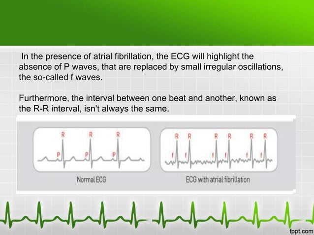 Atrial fibrillation & Atrial flutter | PPTX | Heart and Cardiovascular ...