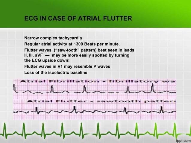 Atrial fibrillation & Atrial flutter | PPTX | Heart and Cardiovascular ...