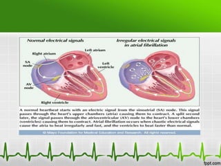 Atrial fibrillation & Atrial flutter | PPTX