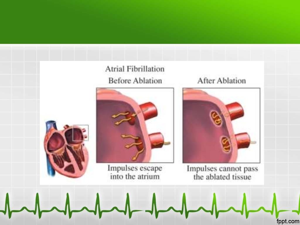 Atrial flutter atrial fibrillation - hetyload