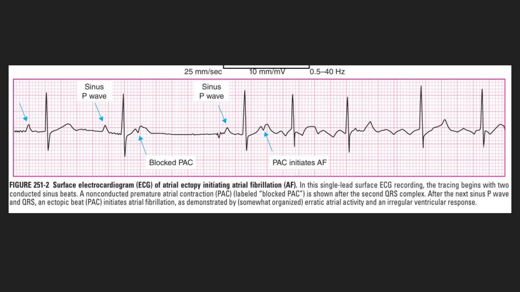 ATRIAL FIBRILLATION - Pathogenesis , Clinical Features & Treatment.pdf