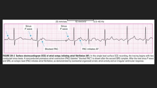 ATRIAL FIBRILLATION - Pathogenesis , Clinical Features & Treatment.pdf