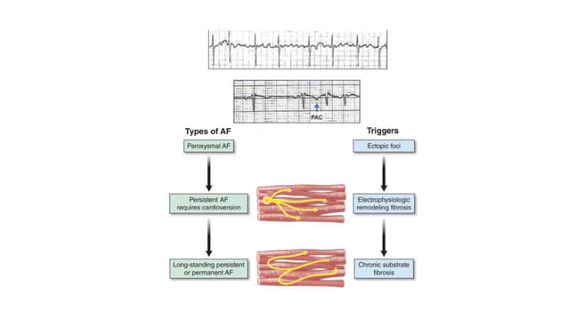 Atrial fibrillation | PPTX