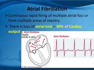 Atrial fibrillation | PPTX
