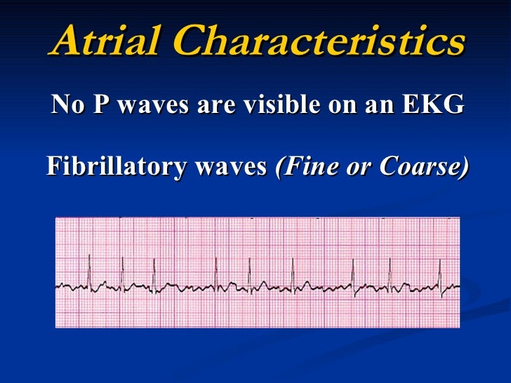 Atrial Fibrillation - BMH/Tele
