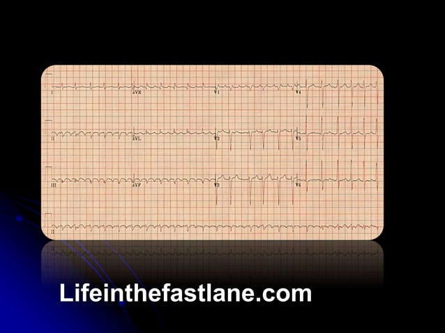 Atrial fibrillation (af) and flutter | PPSX | Heart and Cardiovascular ...