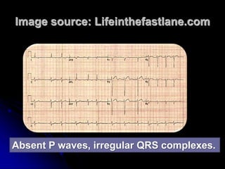 Atrial fibrillation (af) and flutter | PPSX