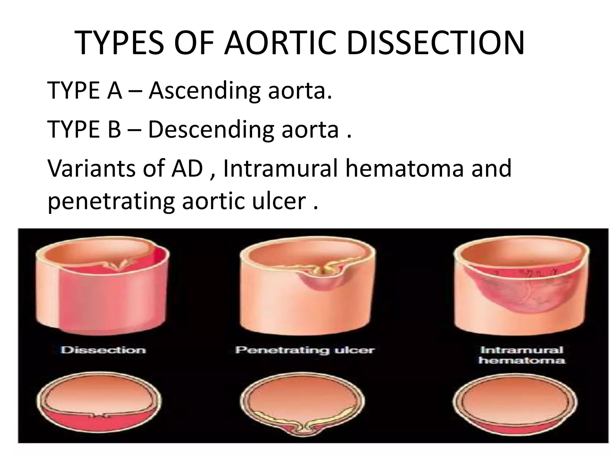 Atrial fibrillation and aortic dissection | PPTX