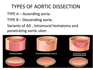 Atrial fibrillation and aortic dissection | PPTX
