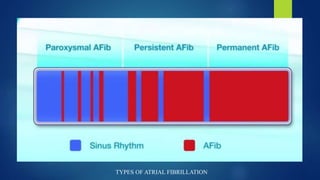 Atrial fibrillation (arrhythmia) | PPTX