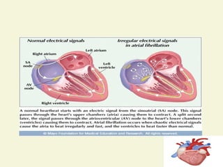 Atrial_Fibrillation_Beige_Background.pptx