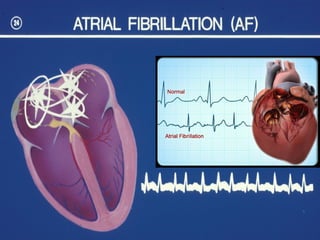 Atrial fibrillation | PPT | Heart and Cardiovascular Diseases ...