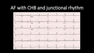 Atrial fibrillation - a surgical perspective | PPTX