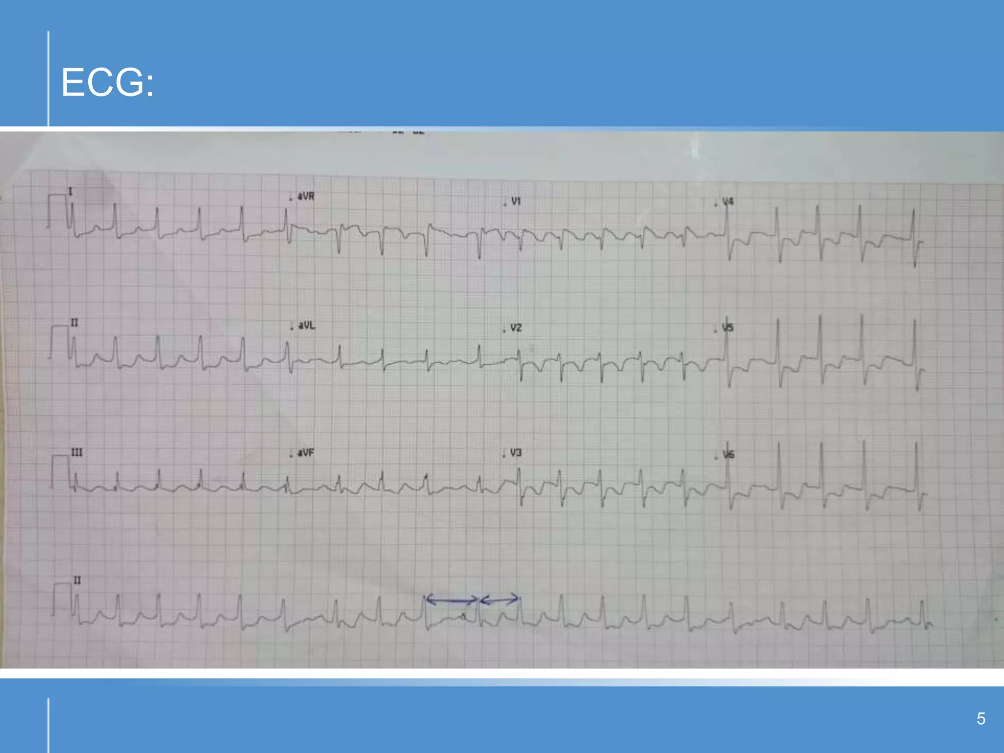 Atrial flutter (AFl) – management principals | PPTX