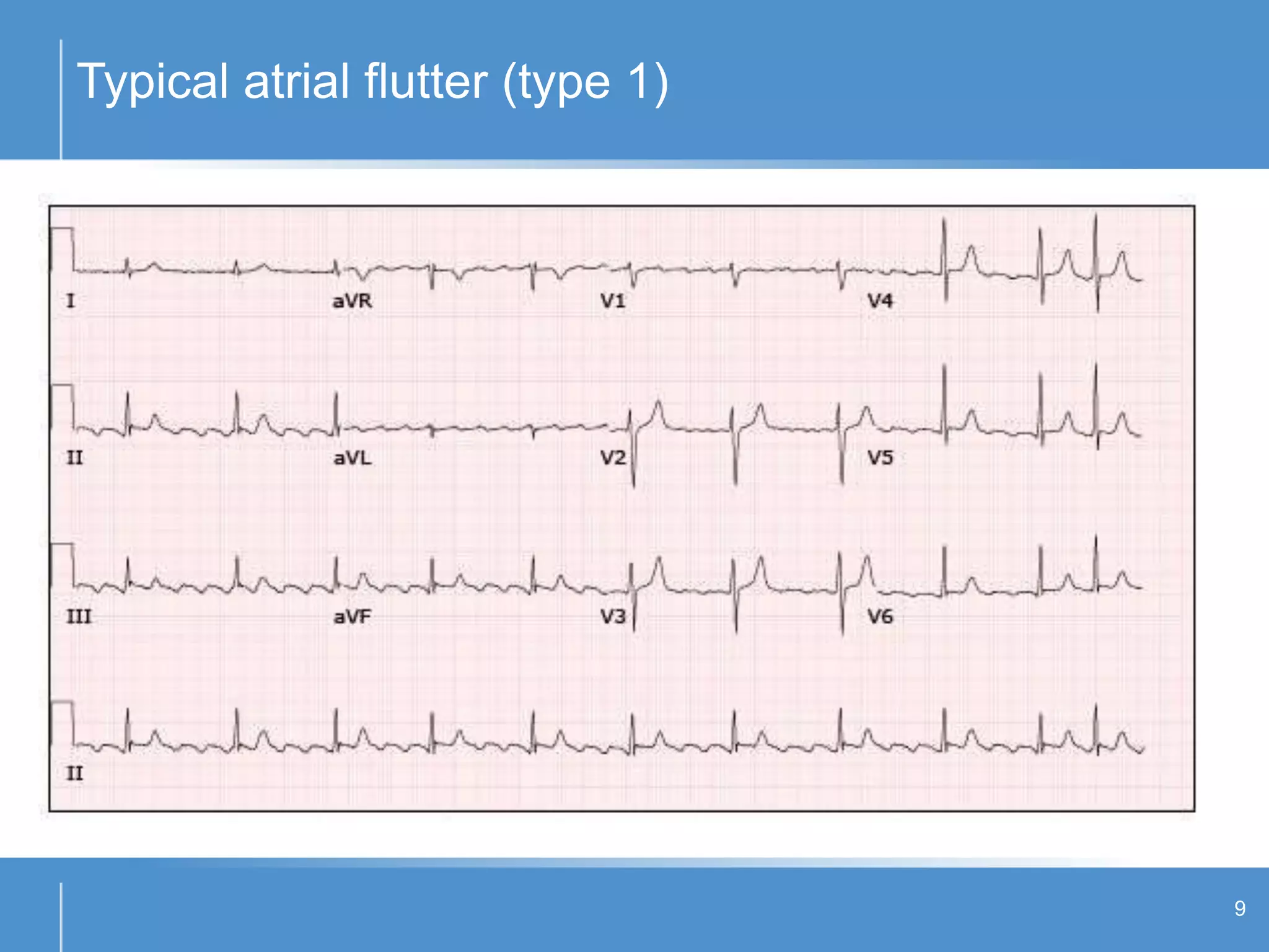 Atrial flutter (AFl) – management principals | PPTX
