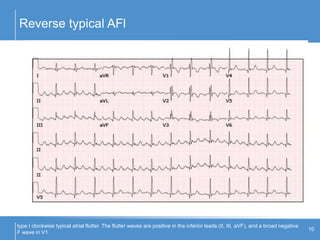 Atrial flutter (AFl) – management principals | PPTX | Ear, Nose and ...