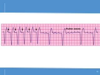 Atrial flutter (AFl) – management principals | PPTX