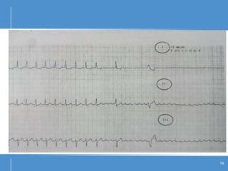 Atrial flutter (AFl) – management principals | PPTX