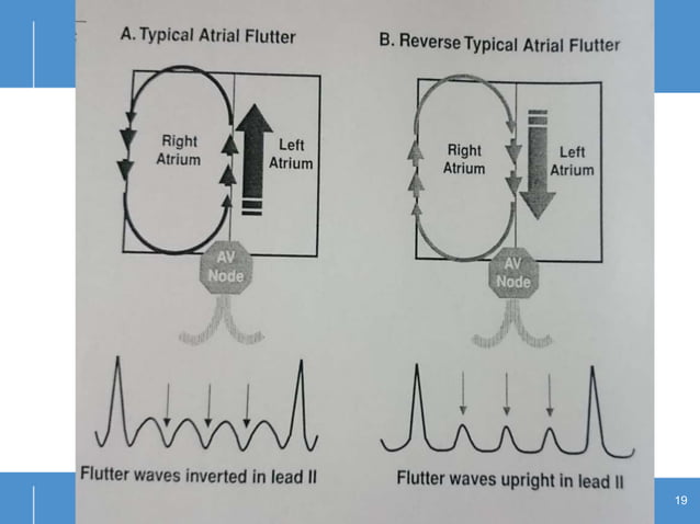 Atrial flutter (AFl) – management principals | PPTX | Ear, Nose and ...