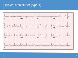 Atrial flutter (AFl) – management principals | PPTX