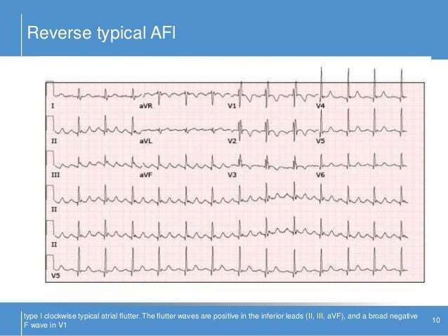 Atrial flutter (AFl) – management principals