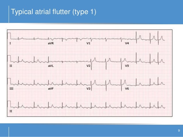 Atrial flutter (AFl) – management principals