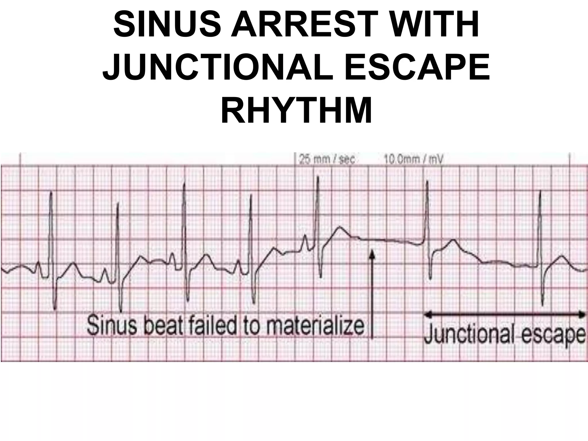 Atrial flutter and bradycardias | PPTX