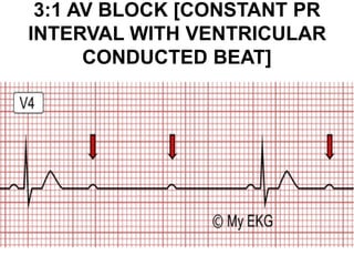 Atrial flutter and bradycardias | PPTX