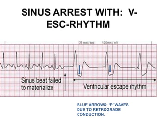 Atrial flutter and bradycardias | PPTX
