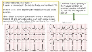 atrial flutter and fibrilationjdjjsjmjdjs | PPTX