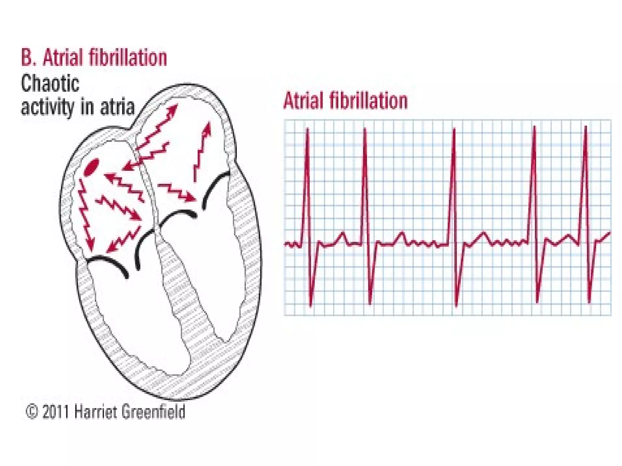 ECG Atrial and Junctional rhythms Dr Sarfaraz | PPT