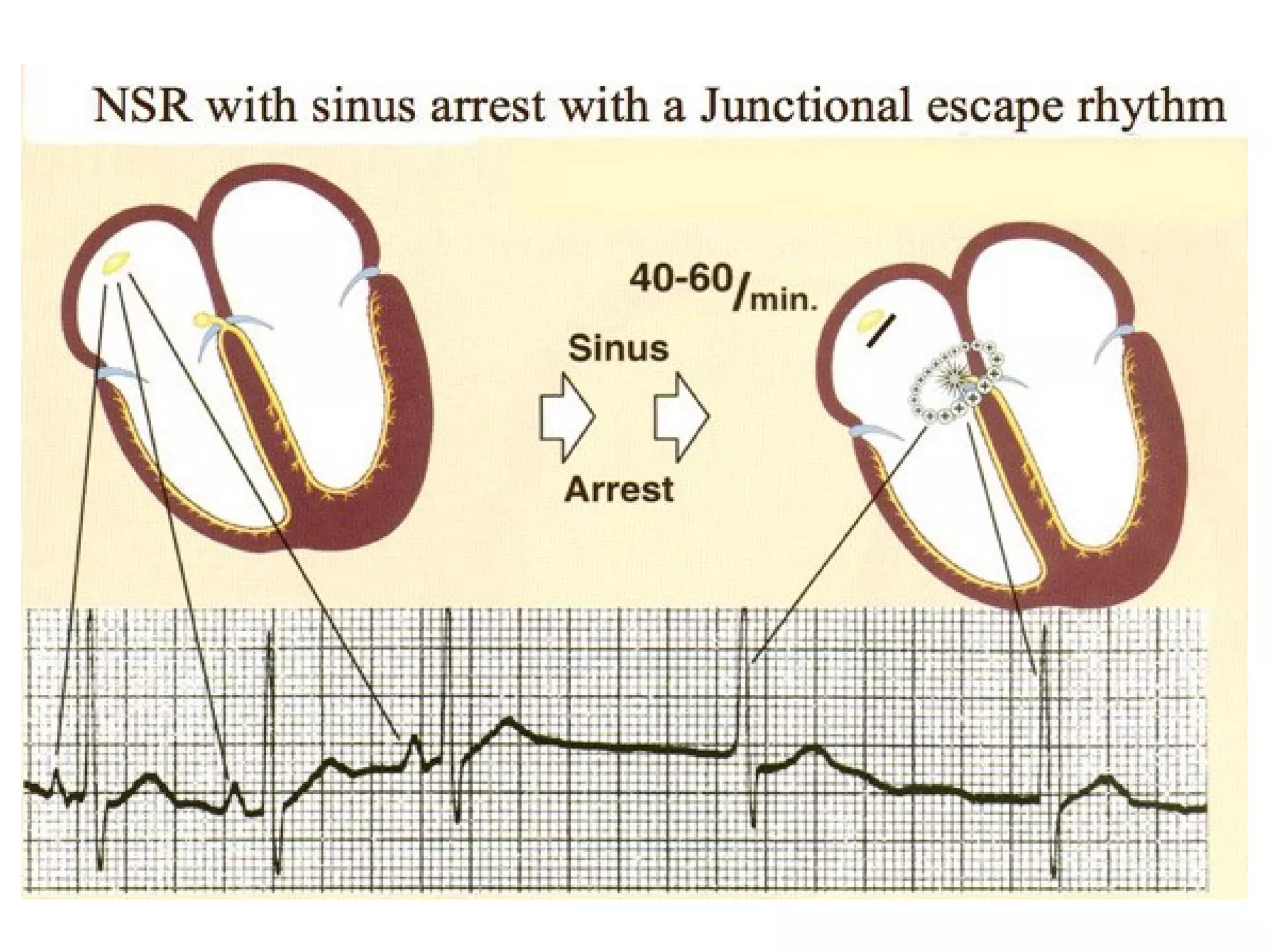 ECG Atrial and Junctional rhythms Dr Sarfaraz | PPT