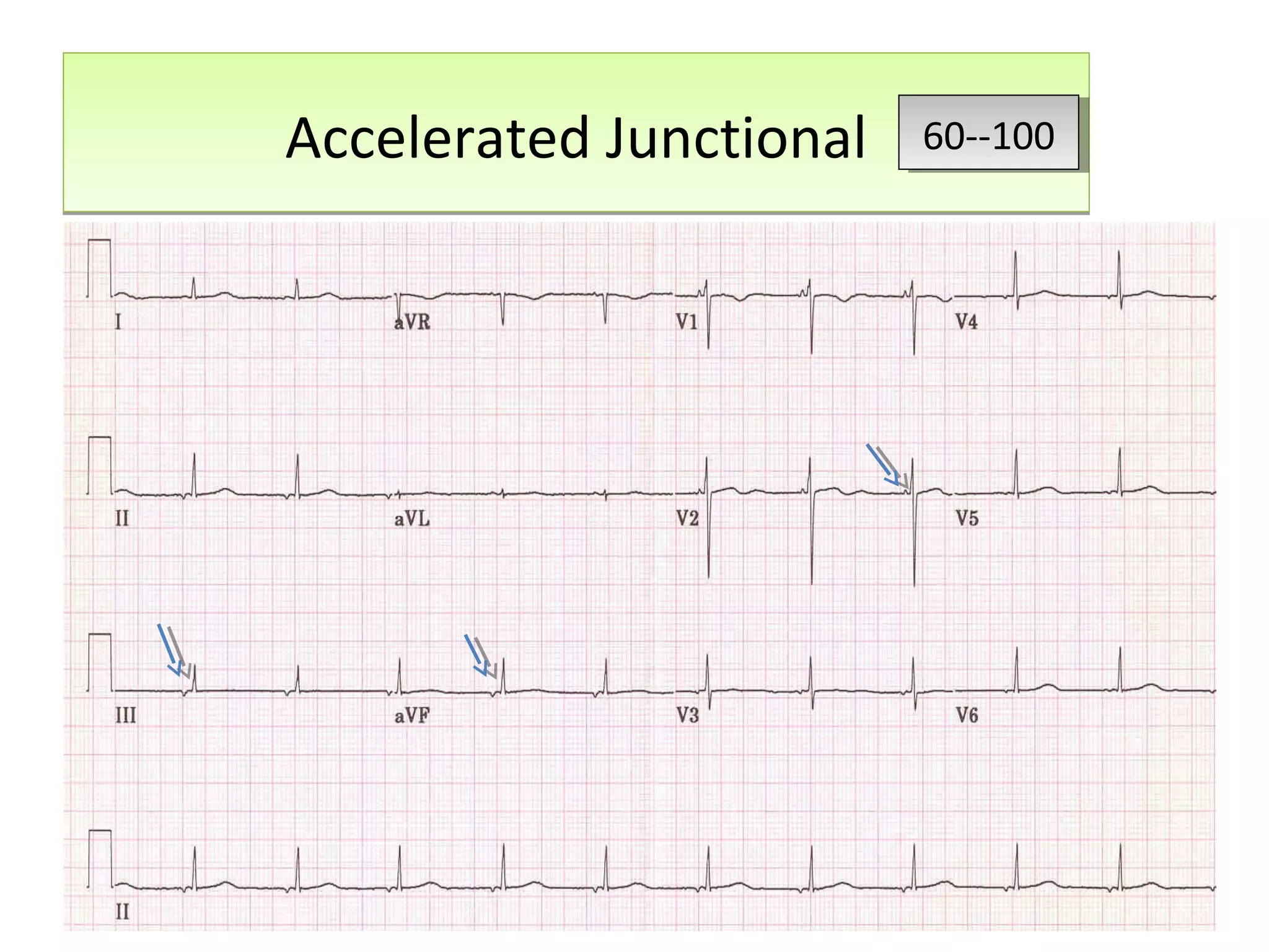 ECG Atrial and Junctional rhythms Dr Sarfaraz | PPT