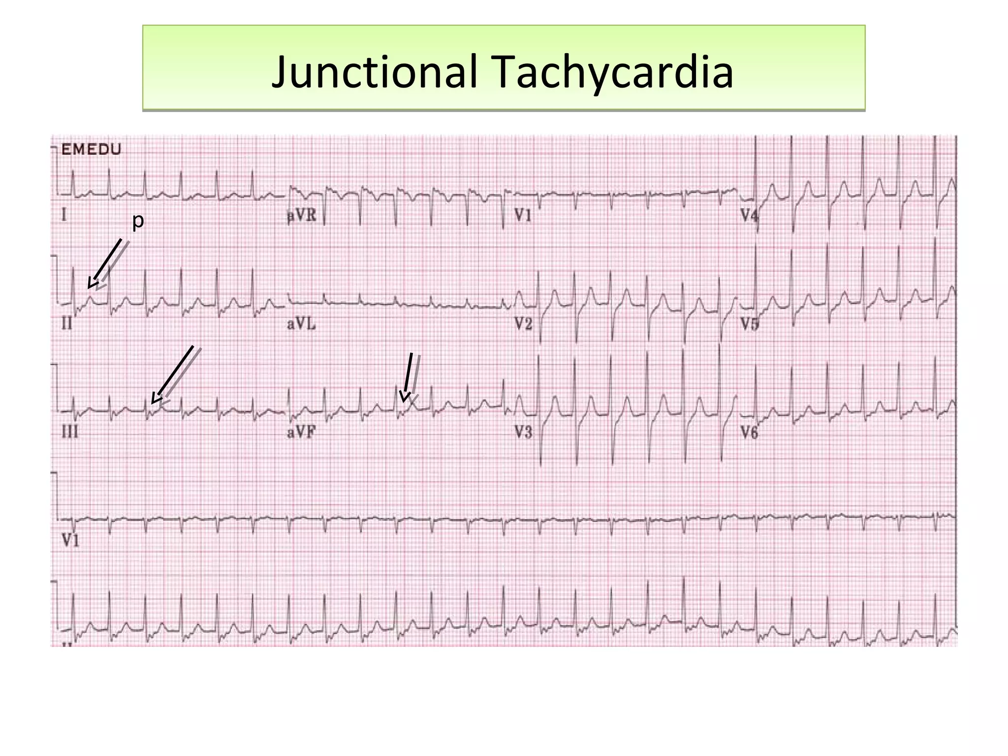ECG Atrial and Junctional rhythms Dr Sarfaraz | PPT
