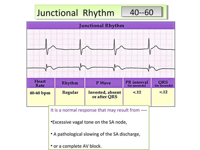ECG Atrial and Junctional rhythms Dr Sarfaraz | PPT