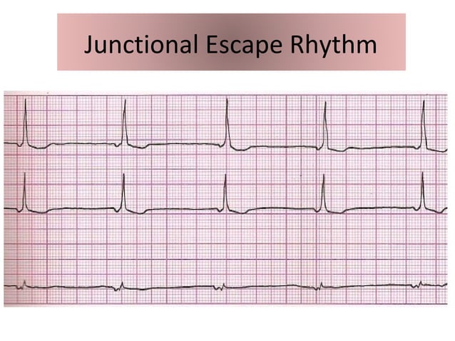 ECG Atrial and Junctional rhythms Dr Sarfaraz | PPT