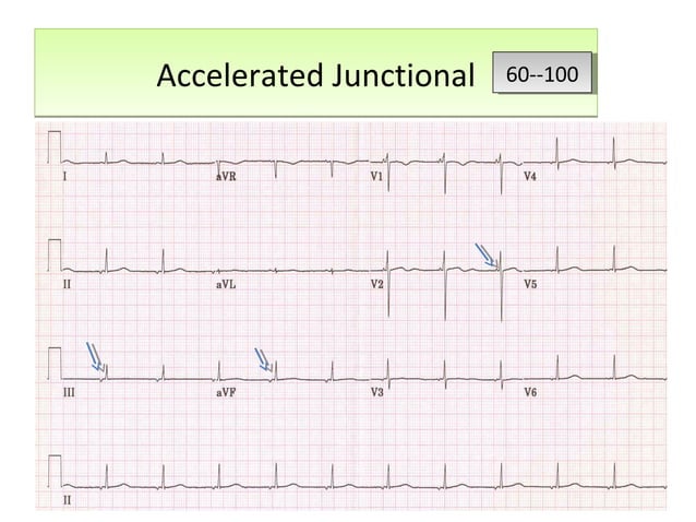 ECG Atrial and Junctional rhythms Dr Sarfaraz | PPT