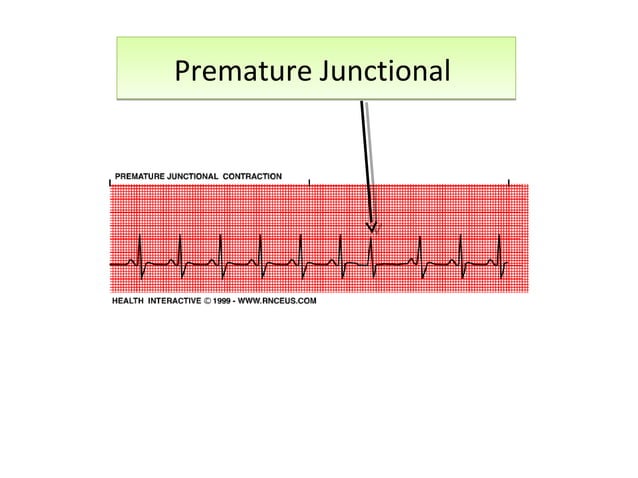 ECG Atrial and Junctional rhythms Dr Sarfaraz | PPT