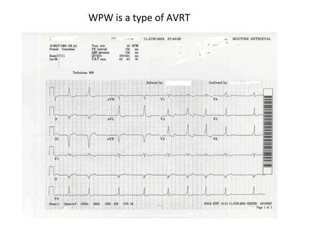ECG Atrial and Junctional rhythms Dr Sarfaraz | PPT