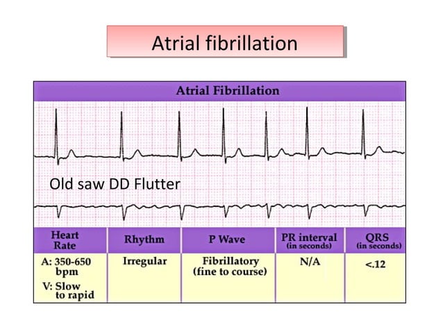 ECG Atrial and Junctional rhythms Dr Sarfaraz | PPT