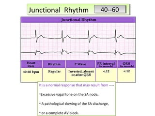 Slow Junctional Rhythm