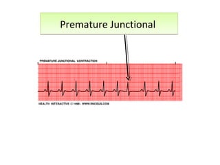 Premature Junctional Contractions