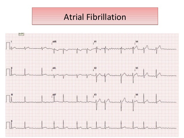 ECG Atrial and Junctional rhythms Dr Sarfaraz