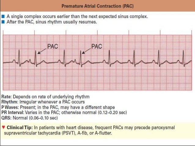 ECG Atrial and Junctional rhythms Dr Sarfaraz